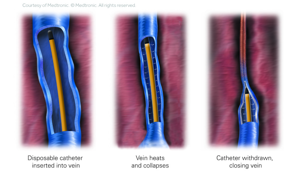 Radiofrequency Vein Treatment Ct Varicose Vein Removal